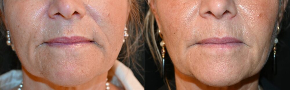 Juläine / PLLA " The Faculty