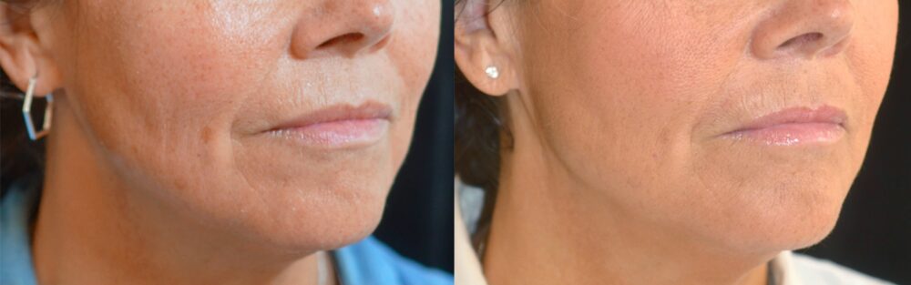 Juläine / PLLA " The Faculty